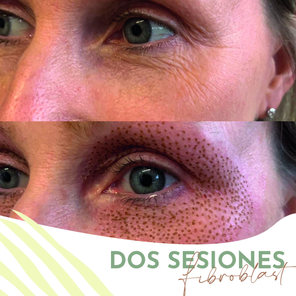 Fibroblast o plasma pen, piel suelta abdomen – Zafi Estetica