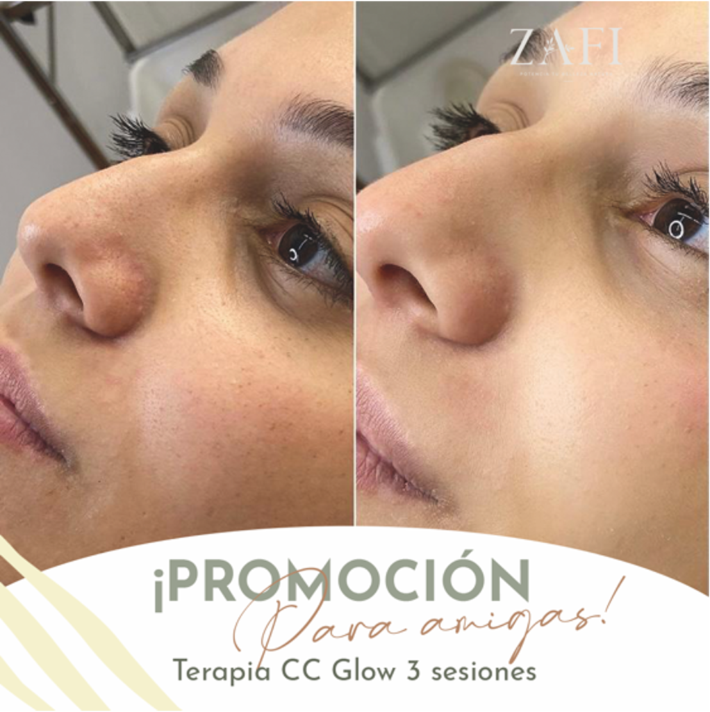 CC Glow 3 sesiones – Zafi Estetica